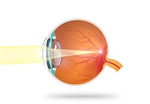 MYOPIA - Red Dot Vision